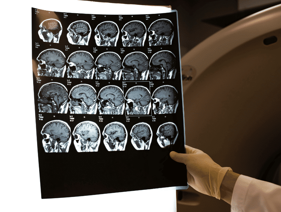 TMS Treatment for Acute Spinal Cord Injury in NYC